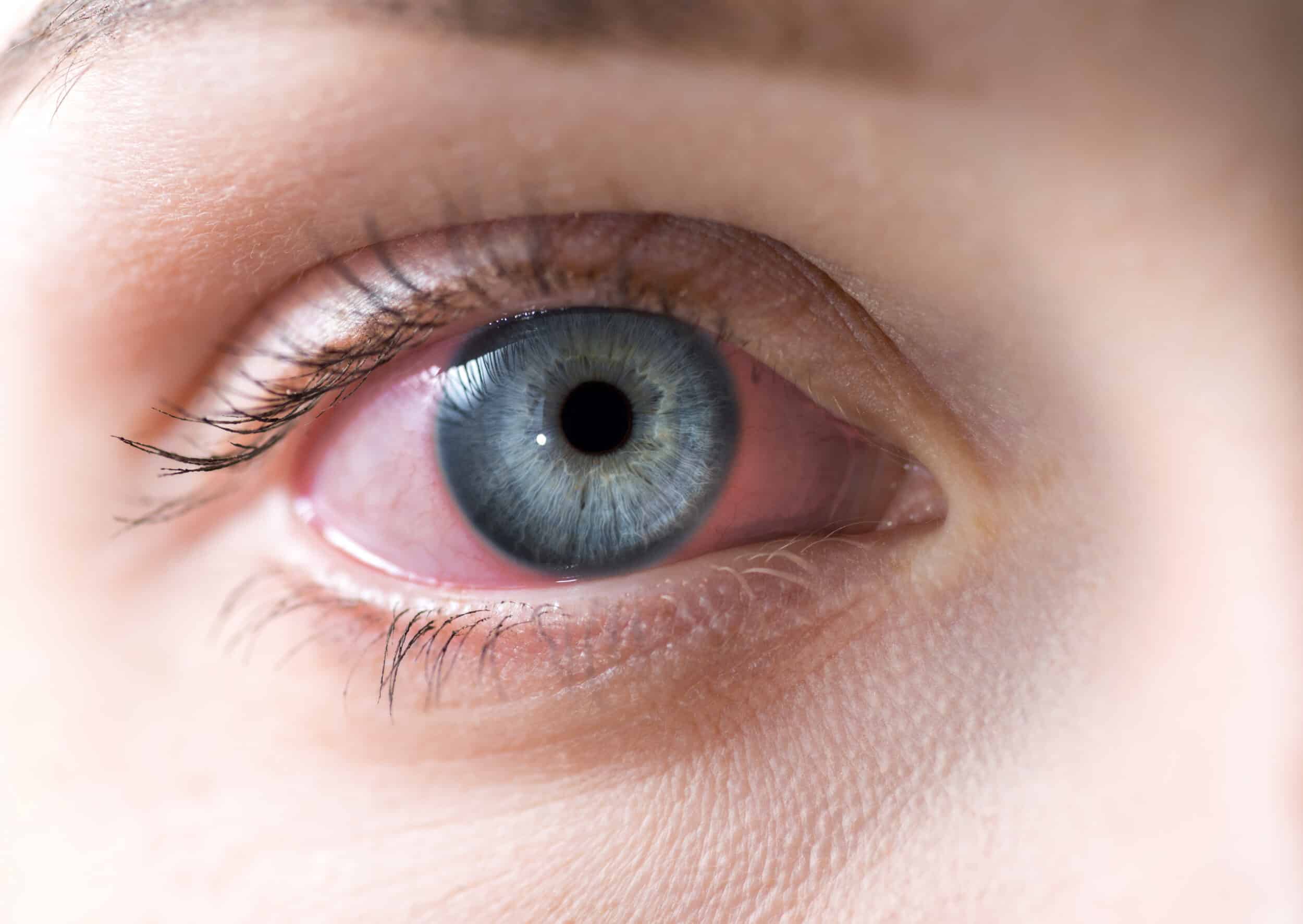 Graves' Disease Eye Treatment in Northbrook, IL | Dr. Daniel Tresley